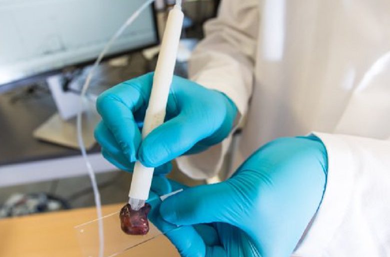 MasSpec Pen, una nueva técnica que facilita la extirpación total del cáncer