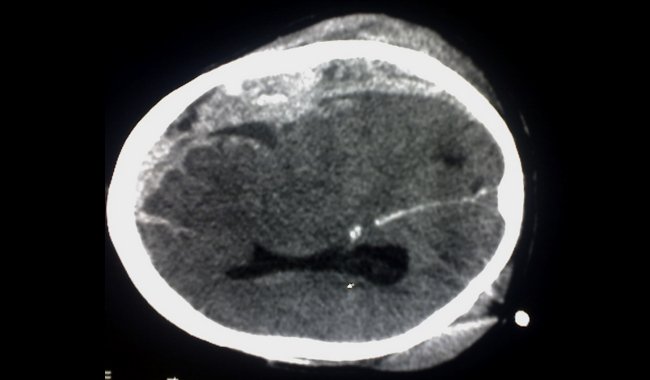 Derrame Subdural; Derrame Subdural de Líquido Cefalorraquidiano ...